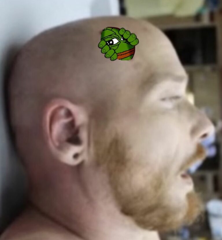 PHOTO Close Up Of Joseph Rosenbaum's Head In The ICU Had Massive Bloody ...