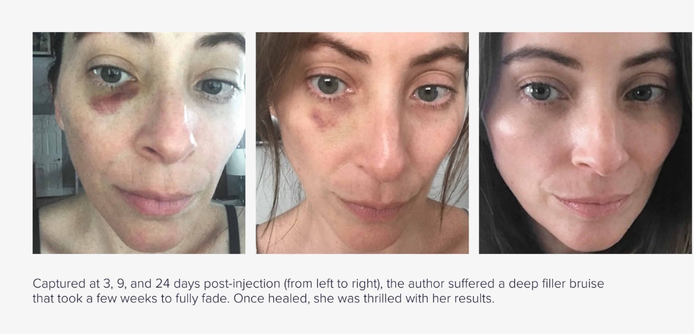 PHOTO Example Of Filler Bruising From Botox Injection That Amber Heard ...