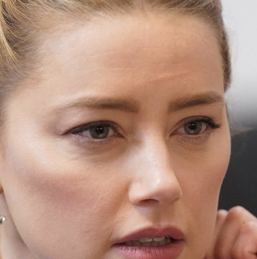 PHOTO Of Amber Heard's Scratch On Her Forehead That She Couldn't Cover ...